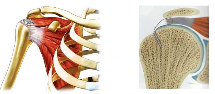 Le lesioni della cuffia dei rotatori – Messina Medica 2.0